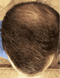 REVIAN RED Hair Growth System | Just the Right Light