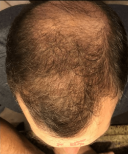 REVIAN RED Hair Growth System | Just the Right Light