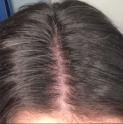 REVIAN RED Hair Growth System | Just the Right Light