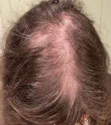 REVIAN RED Hair Growth System | Just the Right Light