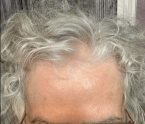 REVIAN RED Hair Growth System | Just the Right Light