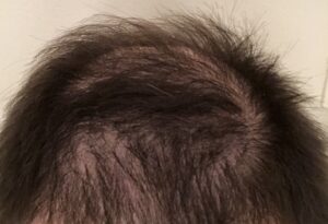 REVIAN RED Hair Growth System | Just the Right Light