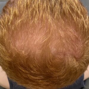 REVIAN RED Hair Growth System | Just the Right Light