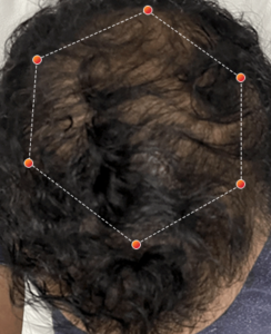 REVIAN RED Hair Growth System | The Right Light for Hair Growth