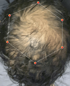 REVIAN RED Hair Growth System | The Right Light for Hair Growth