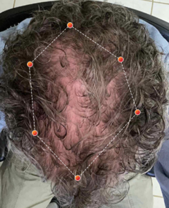 REVIAN RED Hair Growth System | Just the Right Light