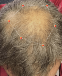 REVIAN RED Hair Growth System | The Right Light for Hair Growth