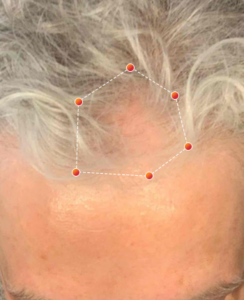 REVIAN RED Hair Growth System | The Right Light for Hair Growth