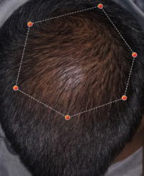 REVIAN RED Hair Growth System | The Right Light for Hair Growth