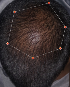 REVIAN RED Hair Growth System | The Right Light for Hair Growth