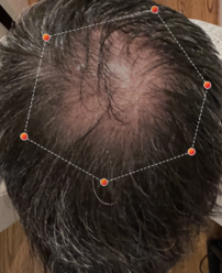 REVIAN RED Hair Growth System | The Right Light for Hair Growth