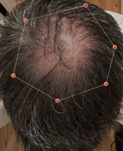 REVIAN RED Hair Growth System | The Right Light for Hair Growth