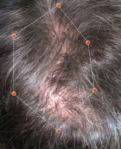 REVIAN RED Hair Growth System | The Right Light for Hair Growth