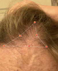 REVIAN RED Hair Growth System | The Right Light for Hair Growth