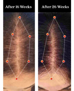 REVIAN RED Hair Growth System | The Right Light for Hair Growth