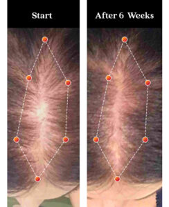 REVIAN RED Hair Growth System | The Right Light for Hair Growth