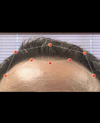 REVIAN RED Hair Growth System | The Right Light for Hair Growth