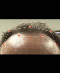 REVIAN RED Hair Growth System | The Right Light for Hair Growth