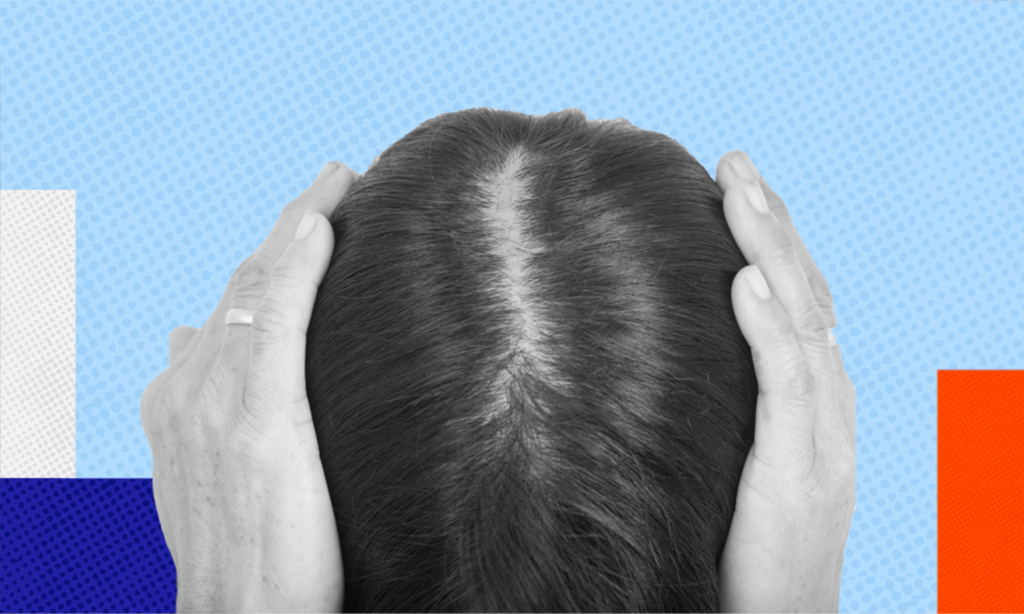Decoding Telogen Effluvium: Unraveling Temporary Hair Loss | Hair Loss ...